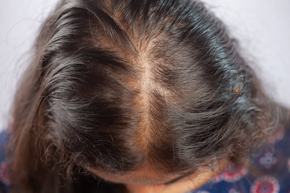 Alopecia androgénica o calvicie común. Tricología en Barcelona.